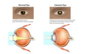 Delaying Cataract Surgery - Axis Eye Clinic