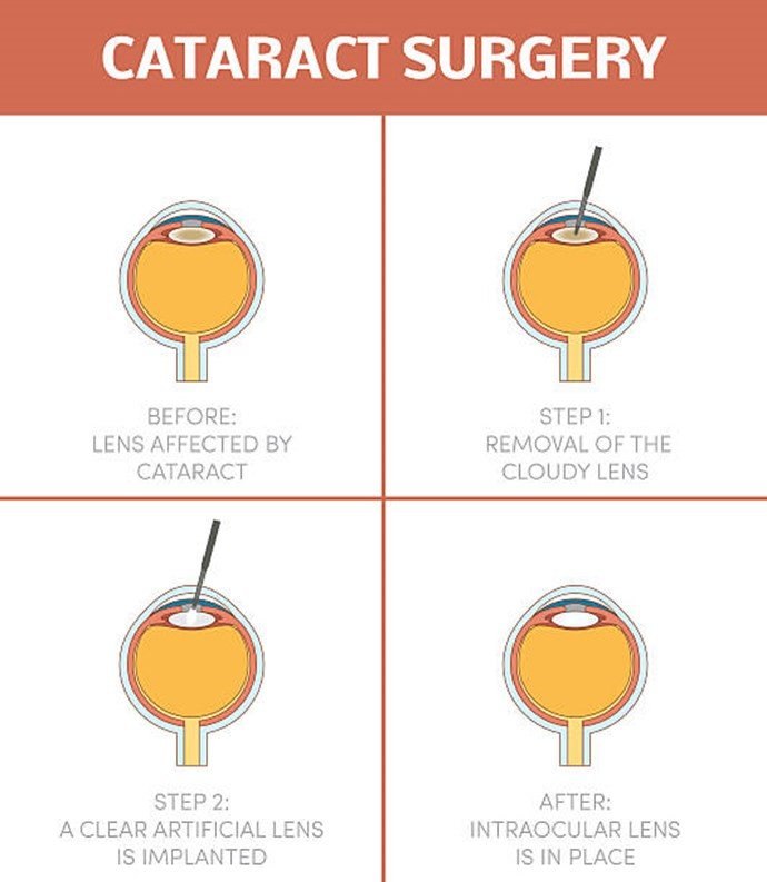 Calming Ways to Prepare for Cataract Surgery - Axis Eye Clinic